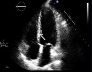 Apical 4 from a Left Lateral Decubitus Position | POCUS Resources ...