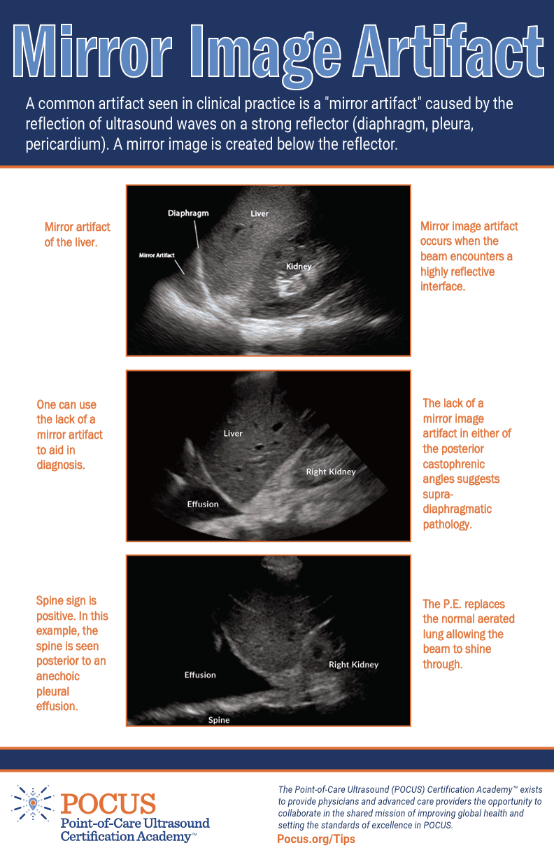 What Is Reflection In Ultrasound