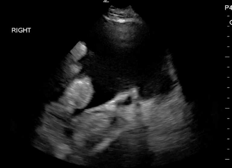 Using Point of Care Ultrasound for Abdominal Trauma