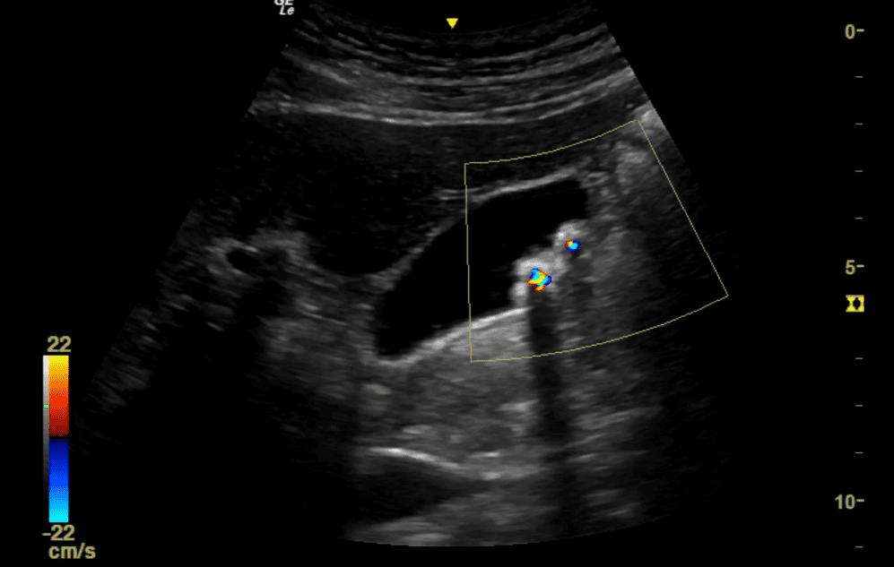 Using Point Of Care Ultrasound For Gallstone Diagnosis Using Point Of Care Ultrasound For Gallstone Diagnosis