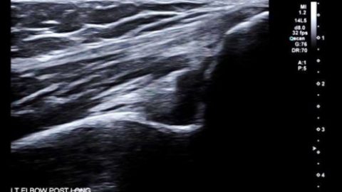 Elbow Swelling | Case Studies | POCUS.org