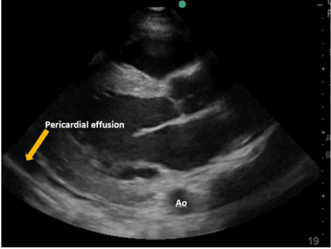 Case Study: Limited Cardiac Exam | Case Studies | POCUS.org