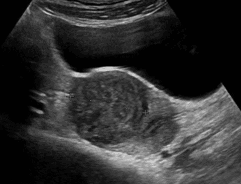 Case Study: Pelvic Ultrasound | POCUS Resources & Case Studies | POCUS.org