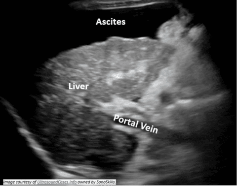 Role of Point of Care Ultrasound (POCUS) in Diagnosing Ascites - Point ...