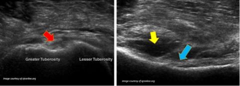 Ultrasound Assessment of the Long Head of the Biceps Tendon (LHBT) – A ...