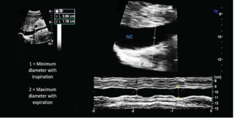 IVC Assessment Guide for POCUS Users - Point-of-Care Ultrasound Certification Academy
