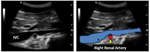 IVC Assessment Guide for POCUS Users - Point-of-Care Ultrasound ...