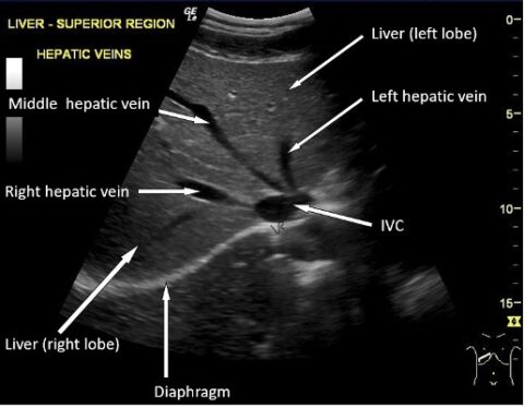 Non-Alcoholic Fatty Liver Disease (NAFLD) - Point-of-Care Ultrasound ...