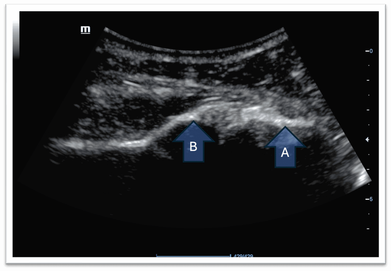 Sonographic Evaluation of a Recurrent Shoulder Dislocation with POCUS ...