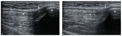 Anisotropy Artifact in Musculoskeletal Ultrasound (MSKUS) - Point-of ...