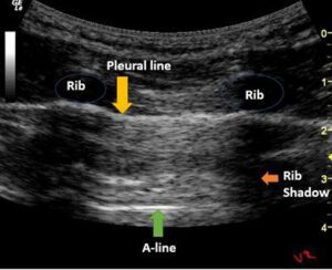 Case Study: Lung Structure Quiz | POCUS Resources & Case Studies ...